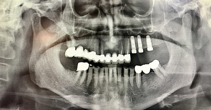 Radio panoramique dentaire à Barbizon - Dentiste Fontainebleau